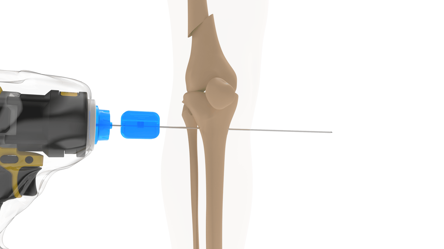 How to Perform: Distal Femoral Traction - Arbutus Medical