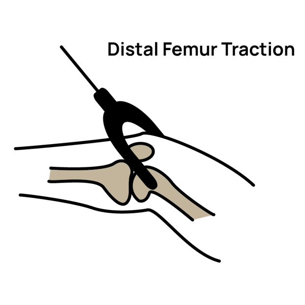 Why or why not skeletal traction? - Arbutus Medical