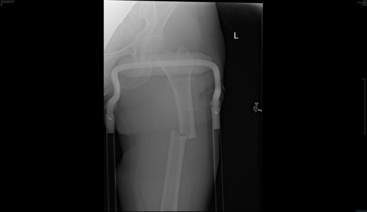 Why or why not skeletal traction? - Arbutus Medical
