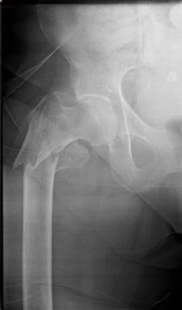 Skeletal Traction After Orthopaedic Trauma – Subtrochanteric Femur ...